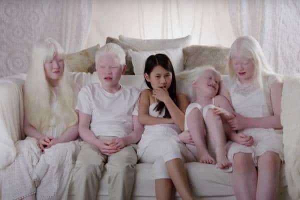 10 Things You Didn’t Know about “Born With Albinism” - TVovermind